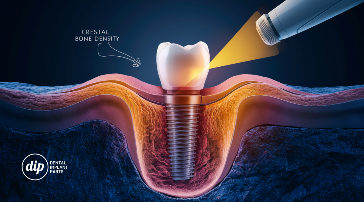 Photobiomodulation on Crestal Bone Density Around Dental Implants